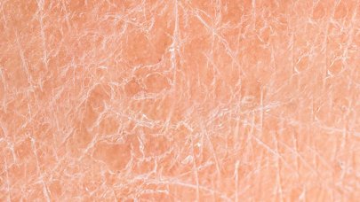 How can you tell the difference between dry skin and dehydrated skin ...